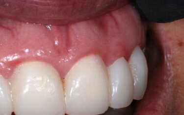 Healing Power: Cervitec Plus helps idealize gingival tissue health ...