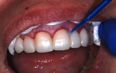 Cervitec Plus: Professional Care | Blog | Ivoclar USA