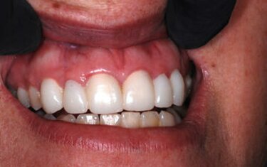 Healing Power: Cervitec Plus helps idealize gingival tissue health ...