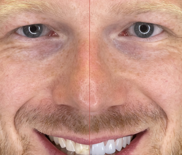 Less is More: Custom Designing a Smile with Minimally Invasive Veneers ...