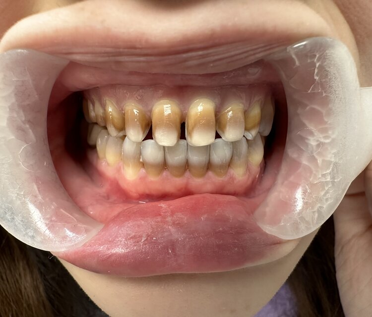 Restoring Severe Tetracycline-Stained Teeth | Blog | Ivoclar NA