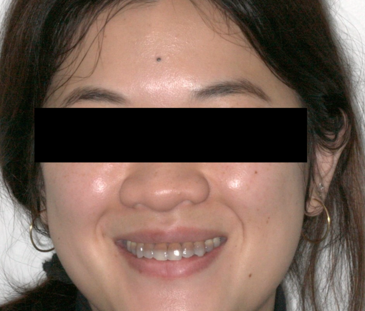 Restoring Severe Tetracycline-Stained Teeth | Blog | Ivoclar NA