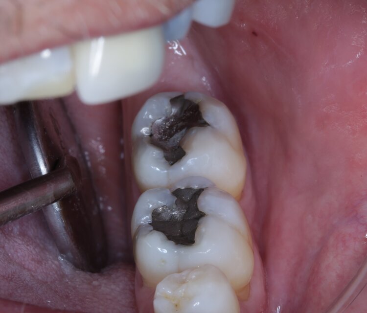 Efficient Posterior Composite Dentistry | Blog | Ivoclar USA