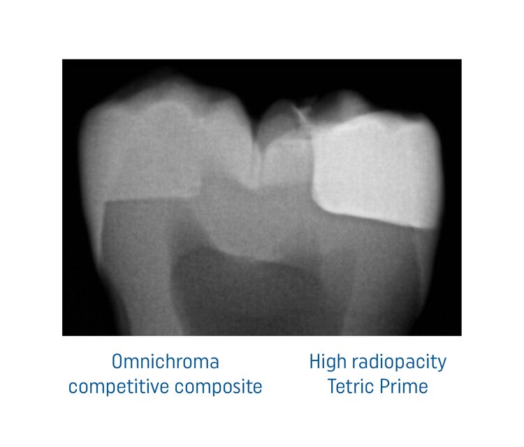 Tetric Prime | Dental Composites | Ivoclar USA
