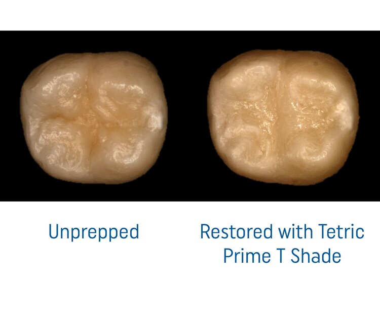 Tetric Prime | Dental Composites | Ivoclar USA