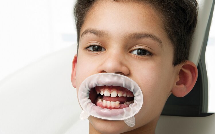 OptraGate | Dental Lip & Cheek Retractors | Ivoclar AU