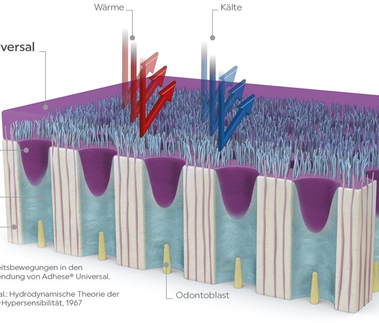 Adhese Universal | Dentaladhäsive | Ivoclar