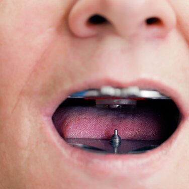 Removable Dental Prosthetics | Dental Workflows | Ivoclar USA