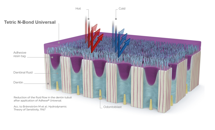 Tetric N-Bond Universal | Ivoclar