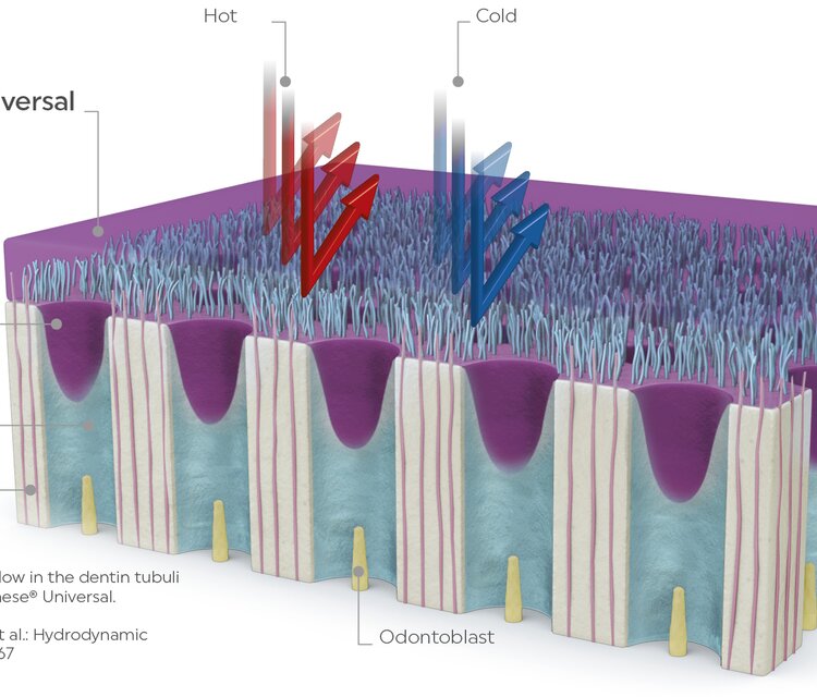 Adhese Universal | Dental Adhesives | Ivoclar USA