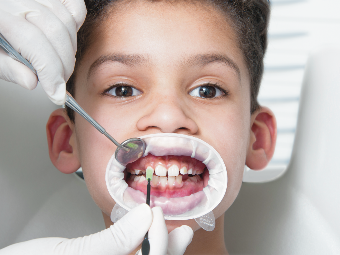 Fluor Protector S | Dental Fluoride Varnish | Ivoclar UK & Ireland