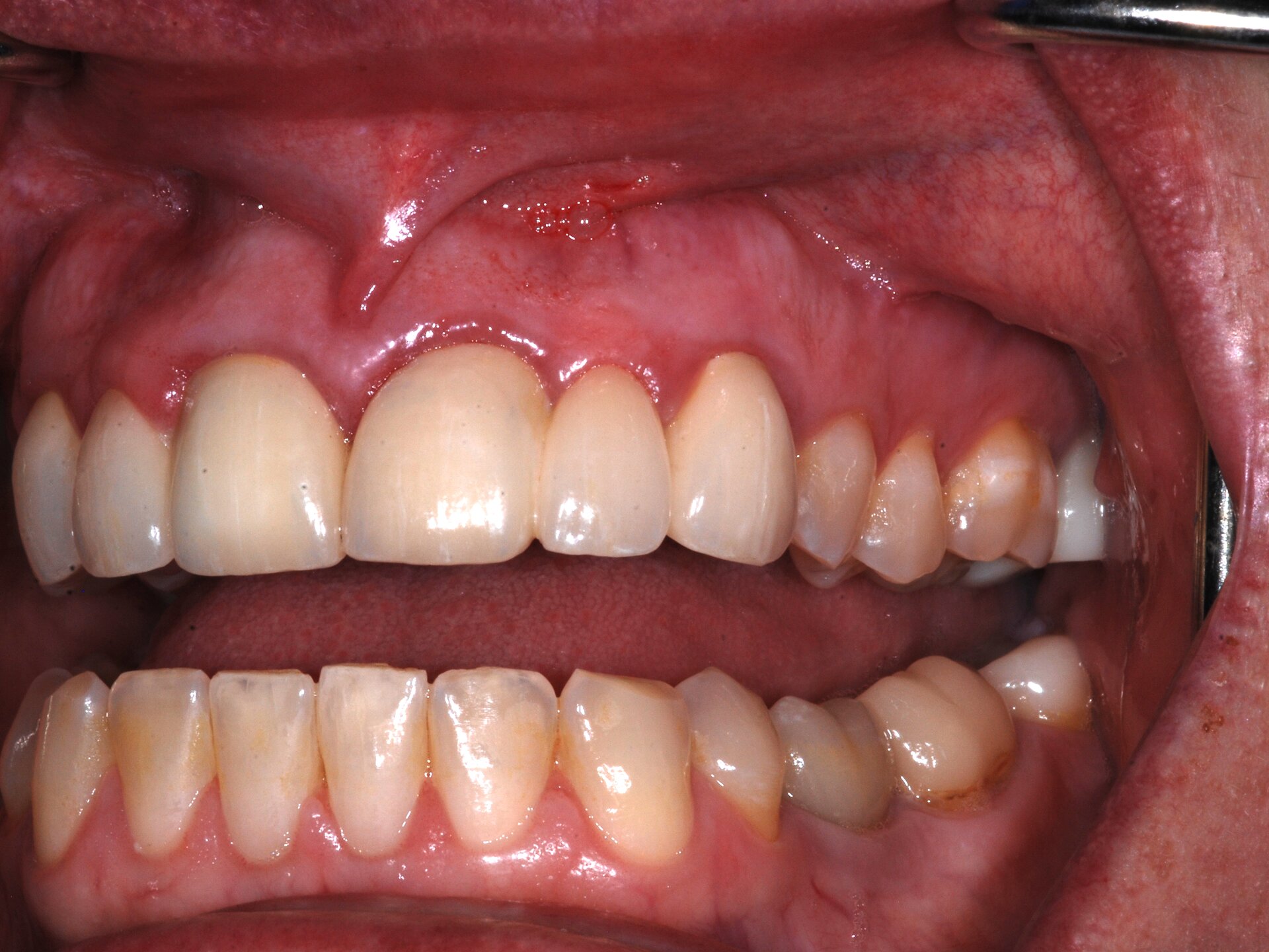 Healing Power: Cervitec Plus helps idealize gingival tissue health ...