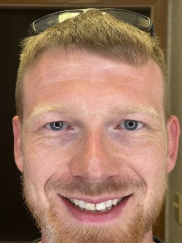 Less is More: Custom Designing a Smile with Minimally Invasive Veneers ...