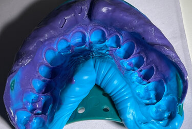 Less is More: Custom Designing a Smile with Minimally Invasive Veneers ...