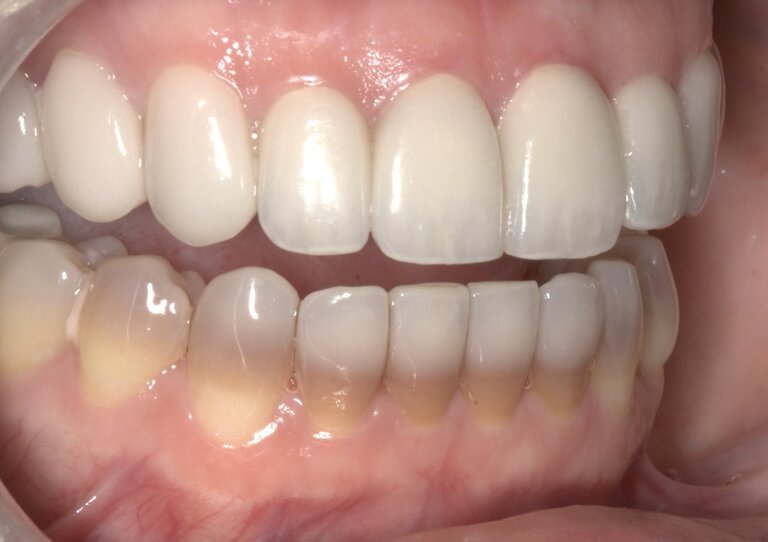 Restoring Severe Tetracycline-Stained Teeth | Blog | Ivoclar NA