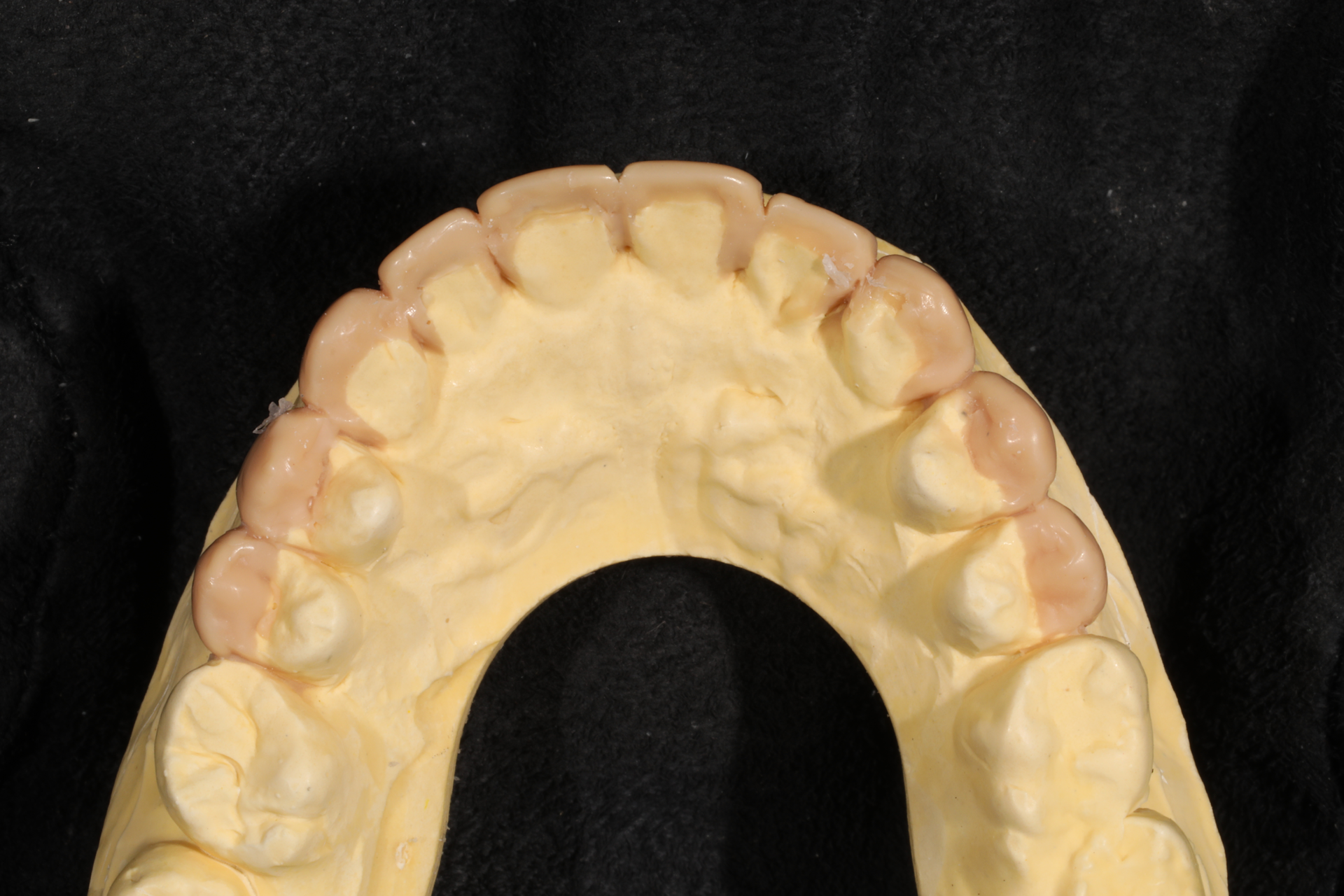 Restoring Severe Tetracycline-Stained Teeth | Blog | Ivoclar NA