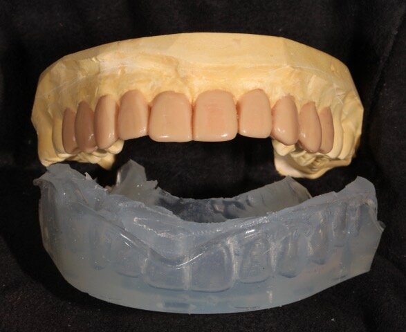 Restoring Severe Tetracycline-Stained Teeth | Blog | Ivoclar NA