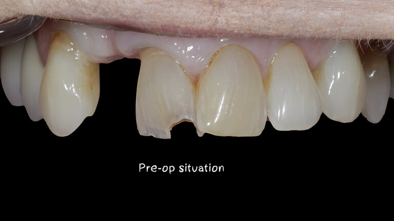 Using Minimally Invasive Dentistry to Guide Treatment Choices