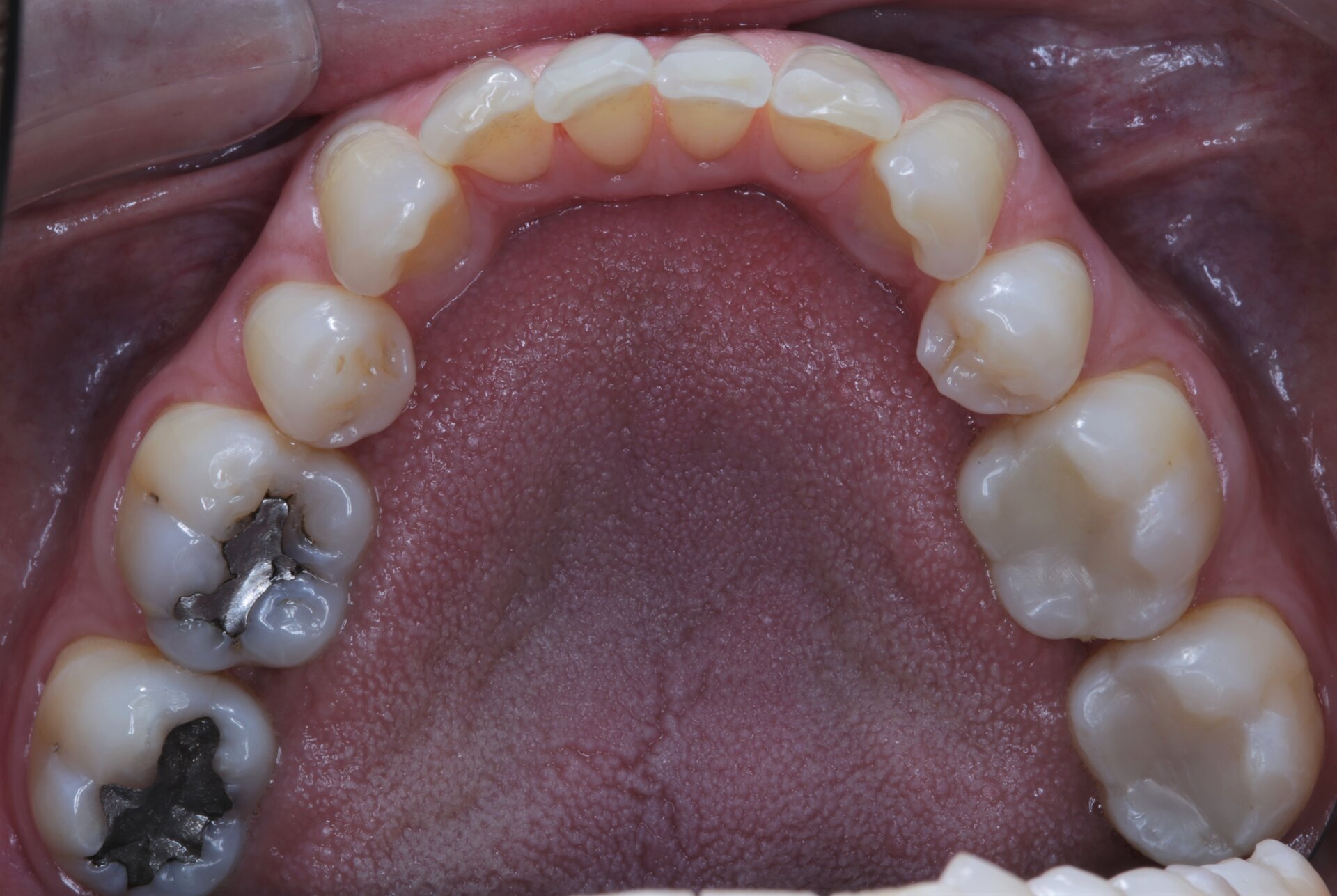Efficient Posterior Composite Dentistry | Blog | Ivoclar USA