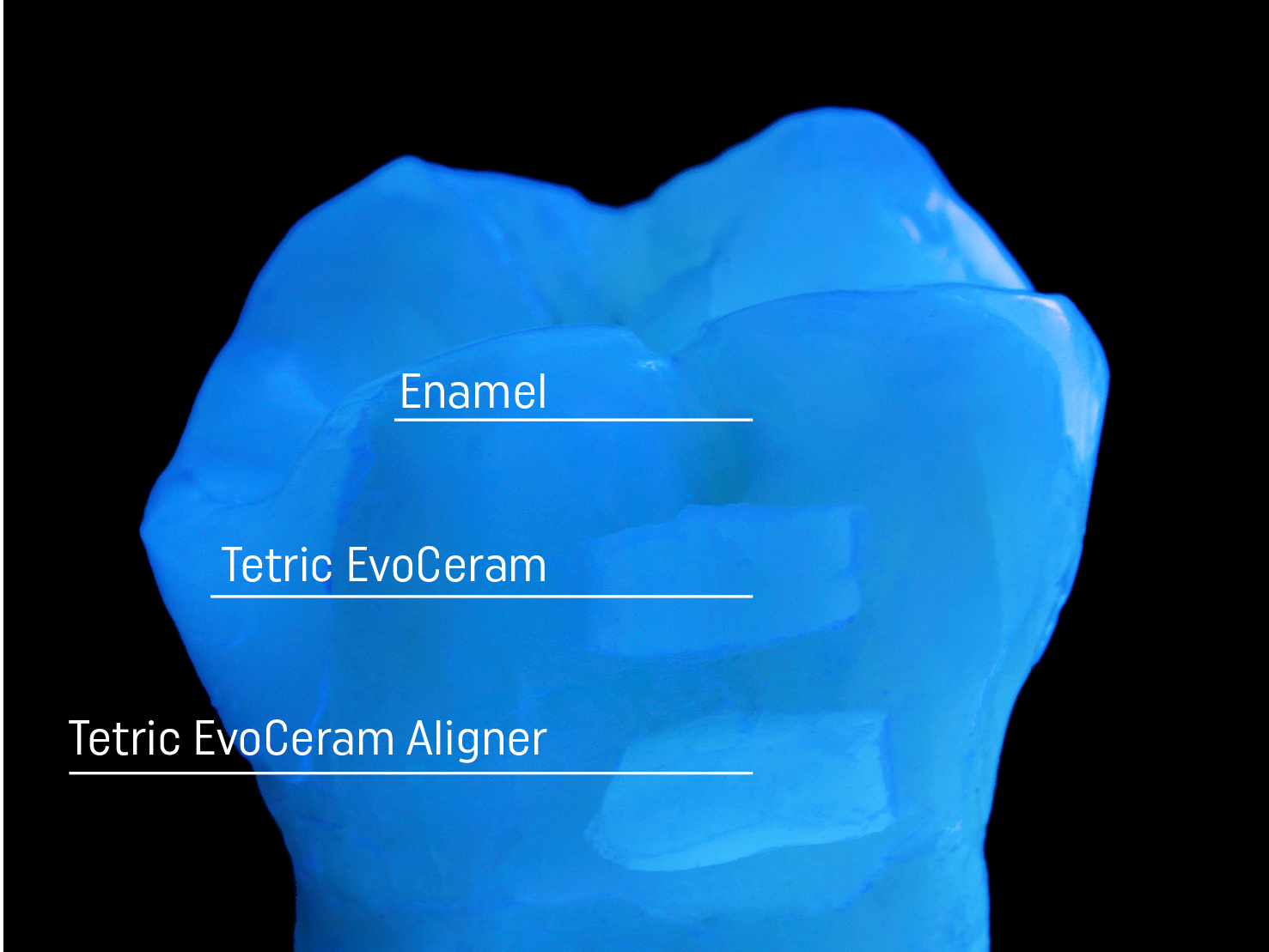 Tetric EvoCeram Aligner | Dental Composites | Ivoclar USA