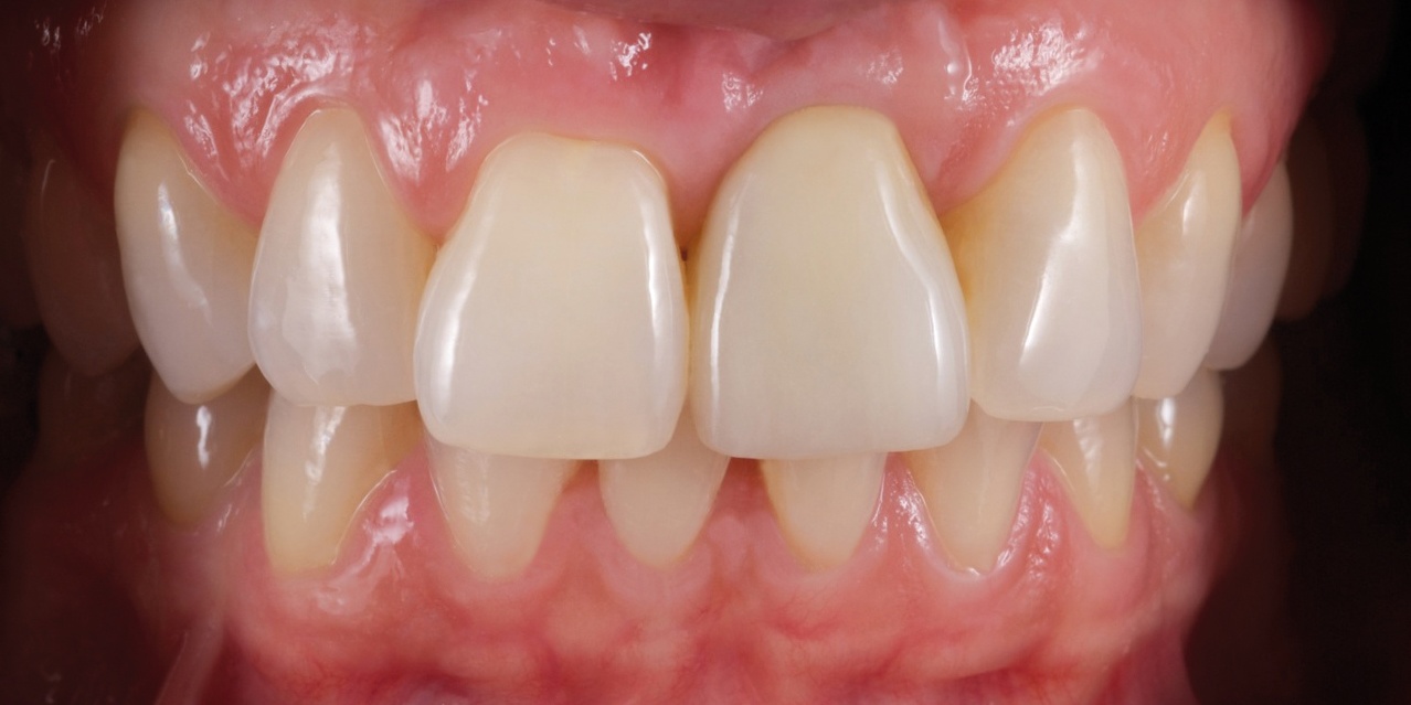 IPS e.max Press Refill MT 5 Stk. | All Ceramics | Ivoclar Vivadent US