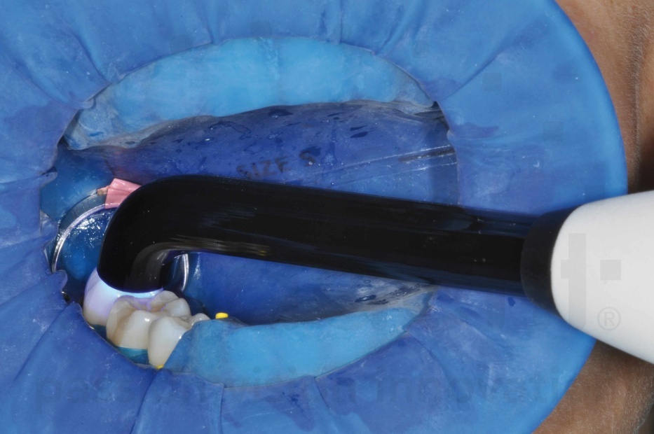 Bluephase Style sleeves Refill 1x50 | Curing Lights & Amalgamators ...